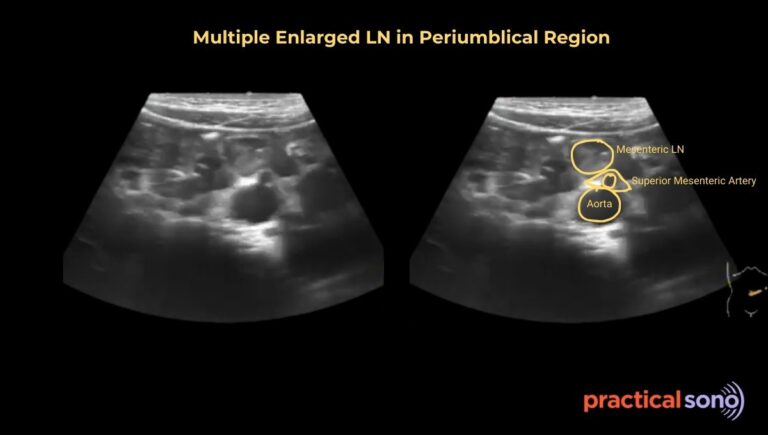 Mesenteric Lymphadenitis Ultrasound [Findings, Diagnostic Criteria ...