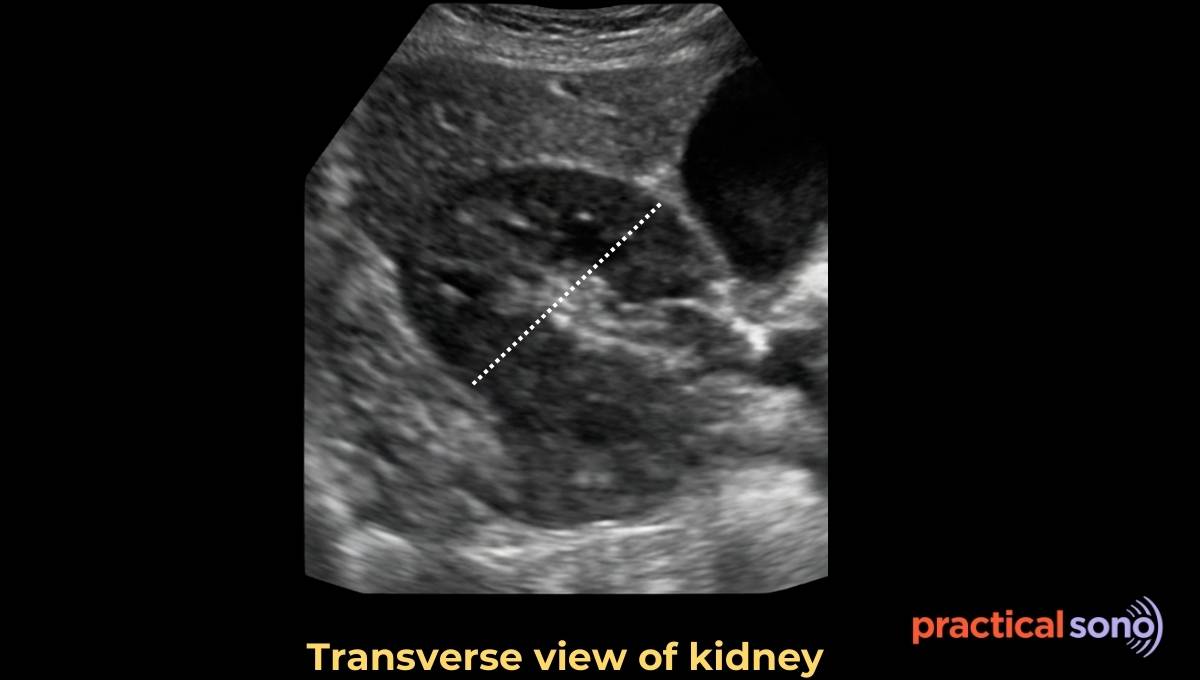 Kidney Measurements During a Renal Ultrasound Scan - Practical Sono