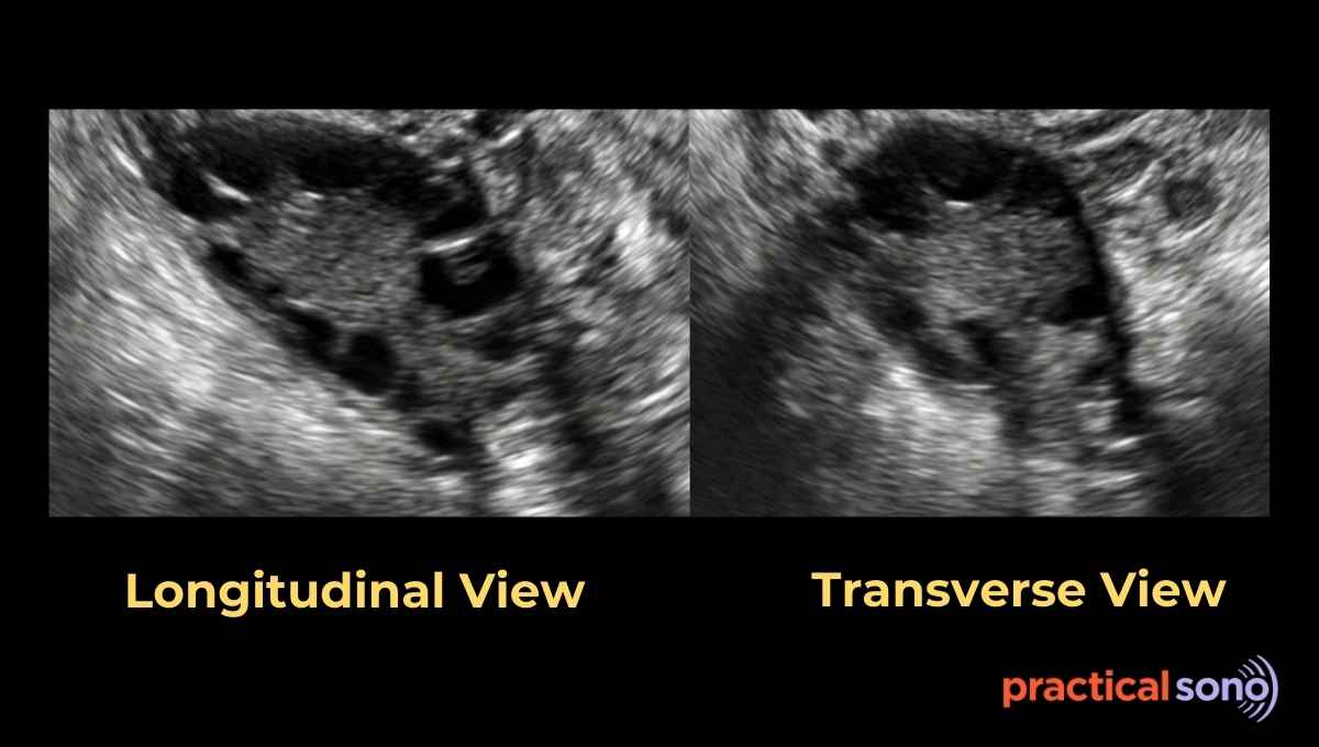 Ovarian Volume Measurement Ultrasound (Standard Technique) - Practical Sono
