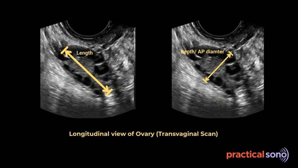Ovarian Volume Measurement Ultrasound (Standard Technique) - Practical Sono
