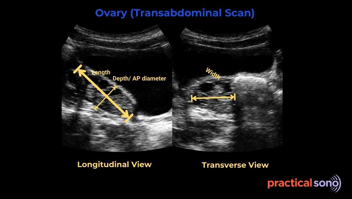 Ovarian Volume Measurement Ultrasound (Standard Technique) - Practical Sono