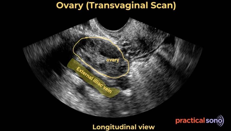 Ovarian Volume Measurement Ultrasound (Standard Technique) - Practical Sono