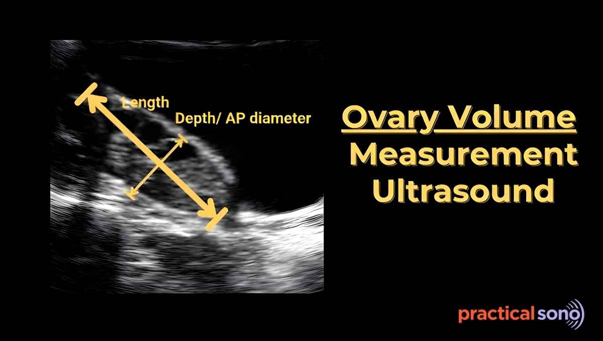 Ovarian Volume Measurement Ultrasound (Standard Technique) - Practical Sono
