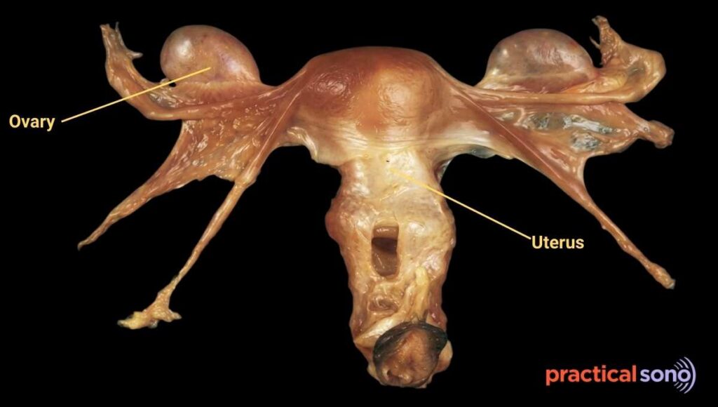 Ovarian Volume Measurement Ultrasound (Standard Technique) - Practical Sono