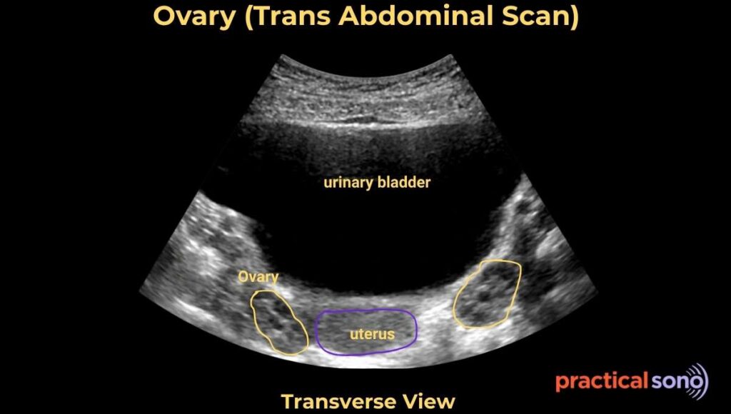 Ovarian Volume Measurement Ultrasound (Standard Technique) - Practical Sono
